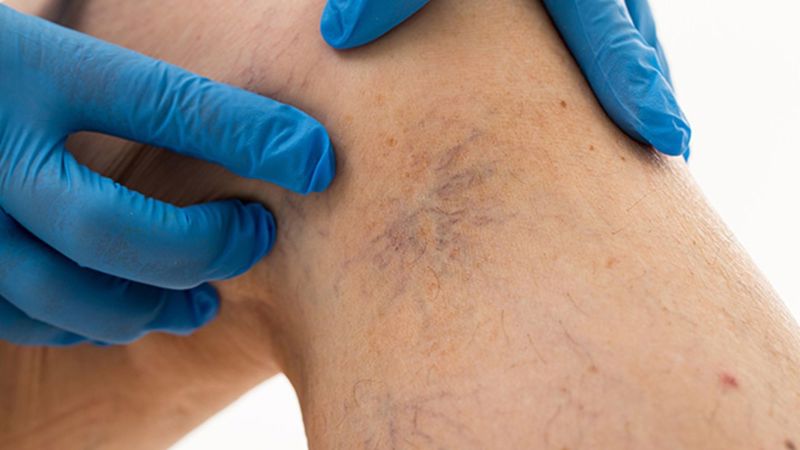 Spataderen | Huid- en lasercentrum Breda