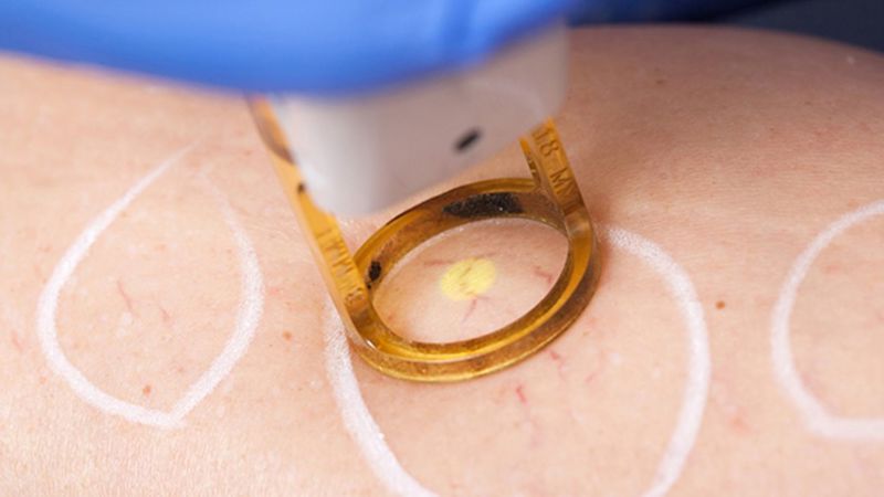 Couperose behandeling | Huid- en lasercentrum